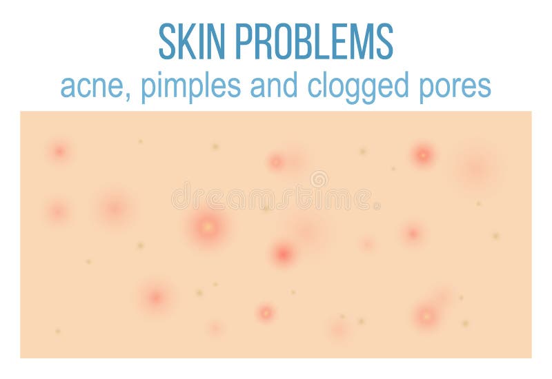 Clogged Skin Pores Stock Illustrations – 130 Clogged Skin Pores Stock ... Clogged Skin Pores Stock Illustrations – 130 Clogged Skin Pores Stock ...