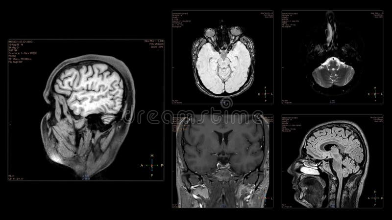 Head MRI Scan from Different Angles Stock Photo - Image of head, mouth ...