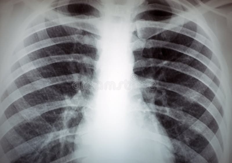 Torax x-ray image stock photo. Image of hospital, diagnosis - 1002792