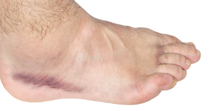 Torcedura do tornozelo. imagem de stock. Imagem de tornozelo - 14449587