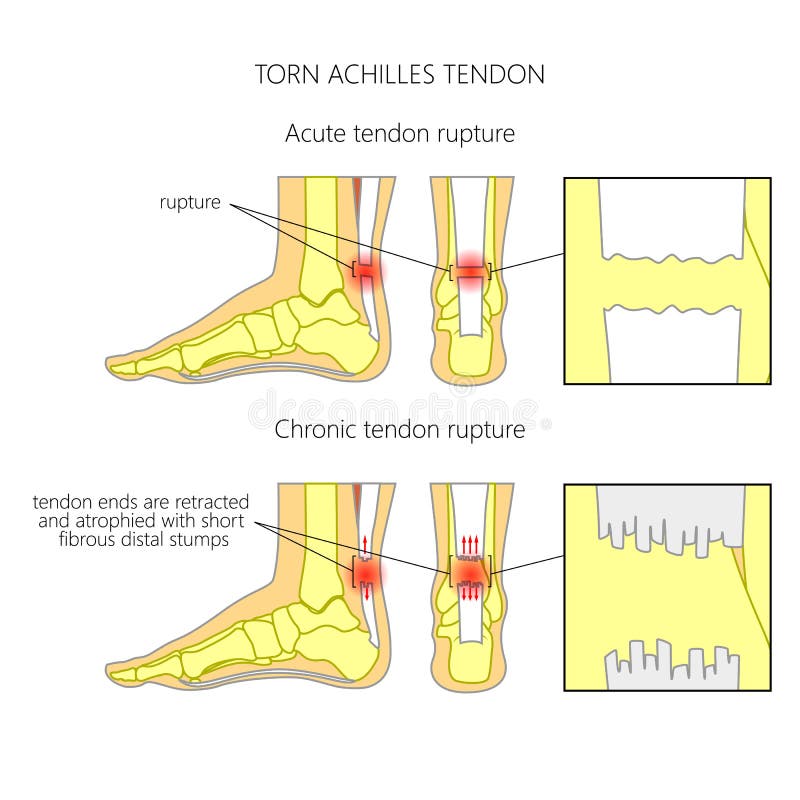 Torn Achilles tendon stock vector. Illustration of graphic - 75243695