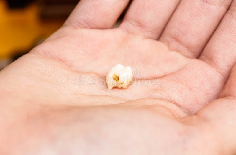 A Torn Baby Tooth in the Child`s Hand Stock Image - Image of case ...