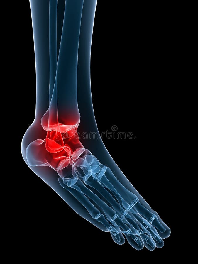 Tornozelo doloroso ilustração stock. Ilustração de anatômico - 5564172