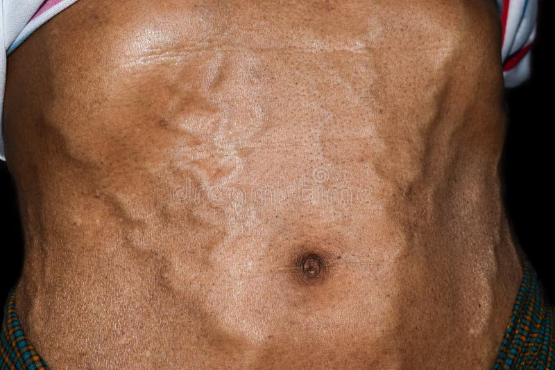 Torturous and Dilated Veins Called Varicose Veins in the Abdomen Stock ... Torturous and Dilated Veins Called Varicose Veins in the Abdomen Stock ...