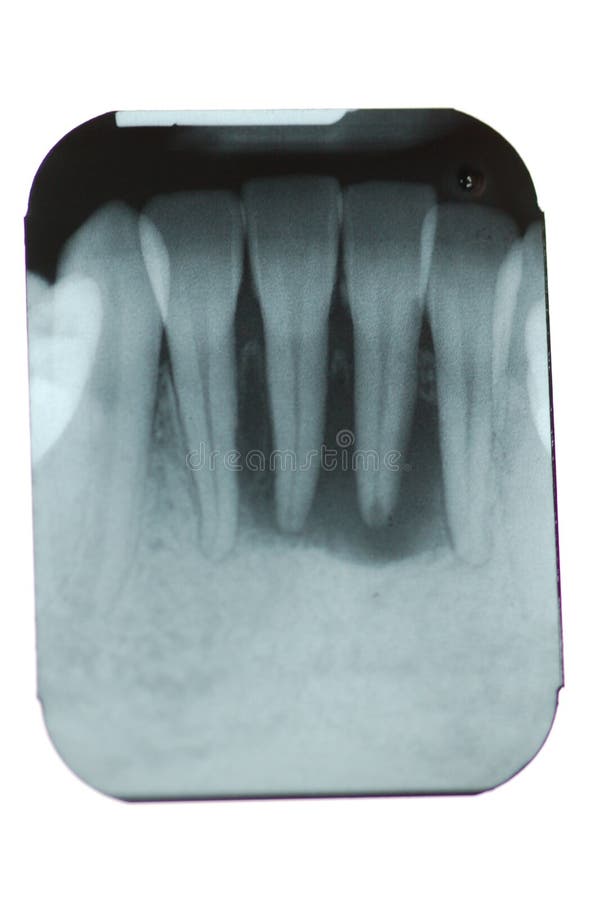 Total Periodontal Bone Loss Stock Photo - Image of bone, gums: 7170900