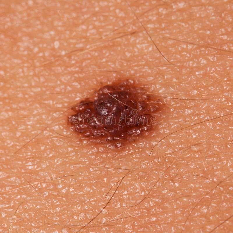 Foto Macro Do Sinal De Nascimento Nevus Na Pele Humana. Fechar. Foto de ...
