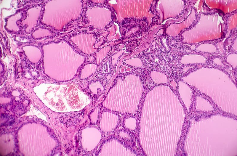 Toxic Diffuse Goiter, or Graves Disease, Light Micrograph Stock Photo ...