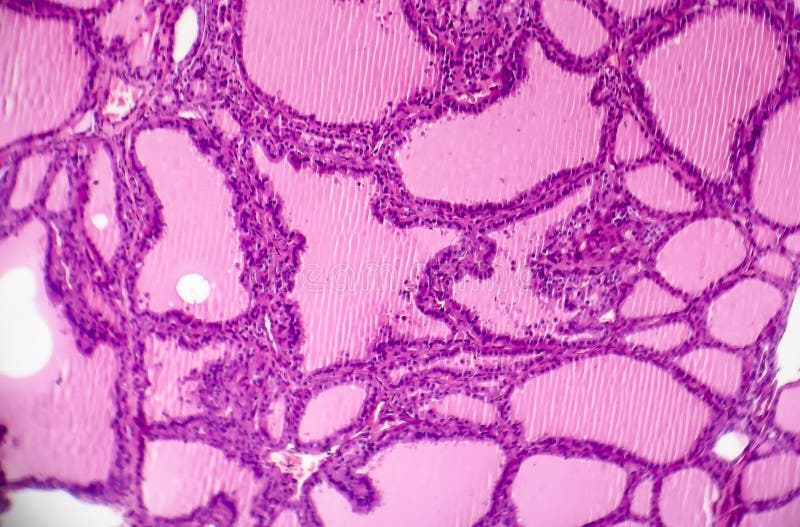 Toxic Diffuse Goiter, or Graves Disease, Light Micrograph Stock Photo ...