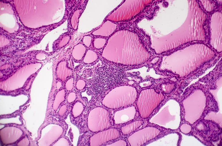 Toxic Diffuse Goiter, or Graves Disease, Light Micrograph Stock Photo ...