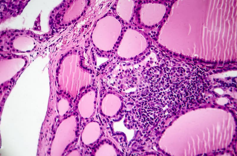 Toxic Diffuse Goiter, or Graves Disease, Light Micrograph Stock Photo ...