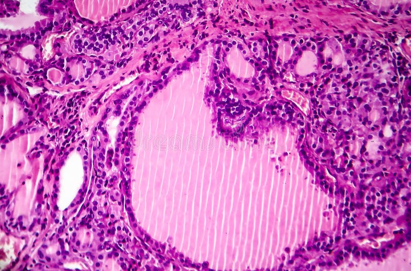 Toxic Diffuse Goiter, or Graves Disease, Light Micrograph Stock Photo ...
