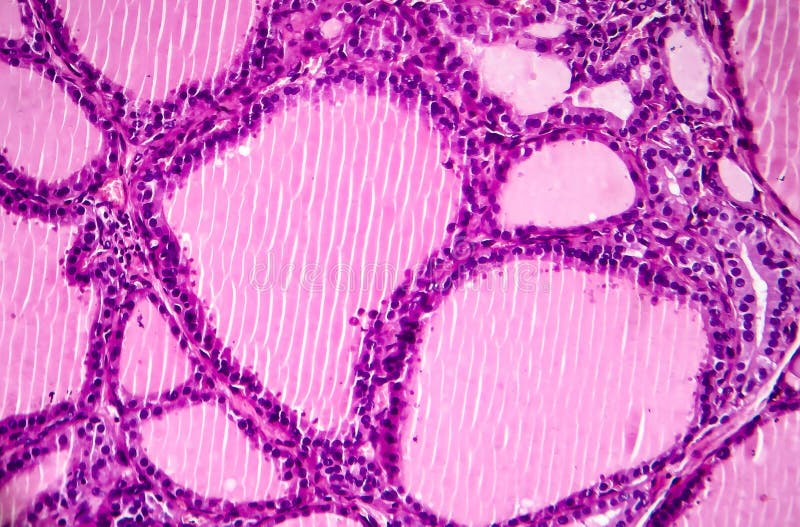 Toxic Diffuse Goiter, or Graves Disease, Light Micrograph Stock Image ...