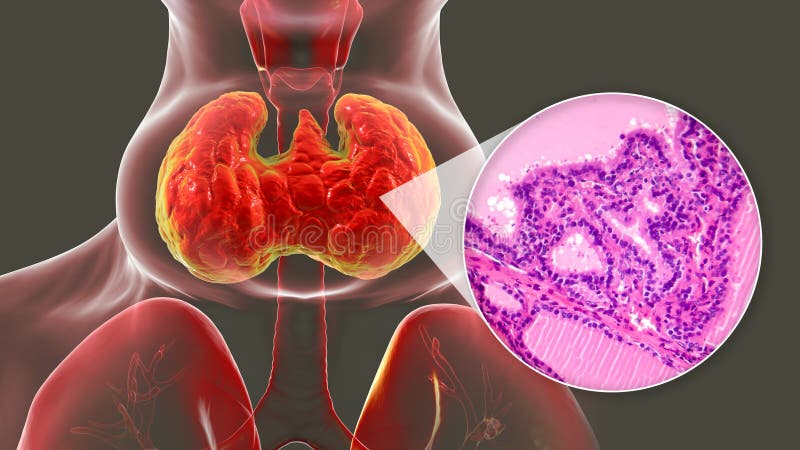 Toxic Goiter, 3D Illustration and Micrograph Stock Illustration ...