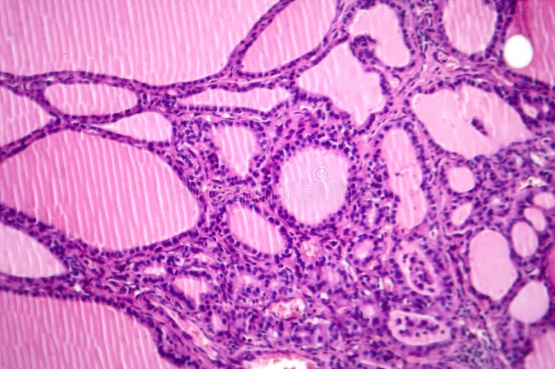 Goiter with Colloid Thyroid Disease Stock Photo - Image of pathology ...