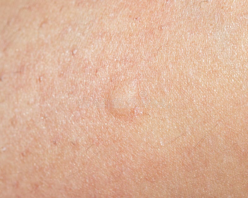 Trace from a Mosquito Bite on the Skin Stock Image - Image of allergy ...