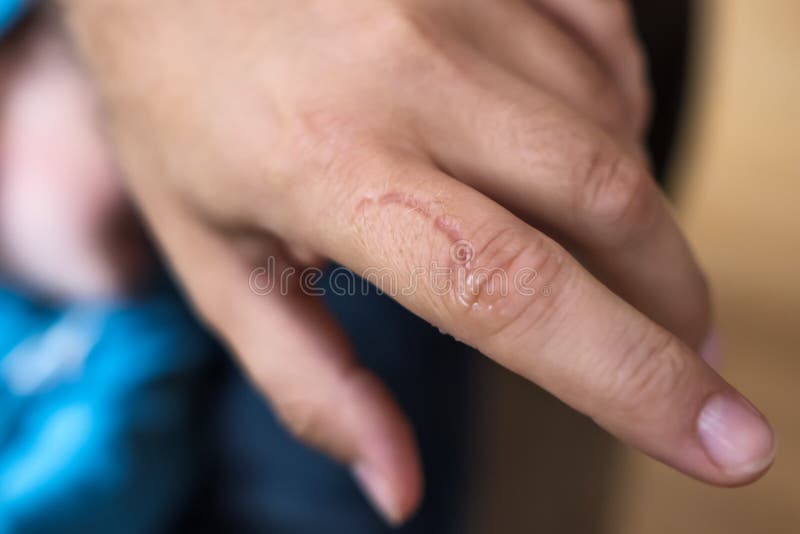 Trace Of Teeth Bite On Skin. Bad Behavior Of Child Stock Image - Image ...