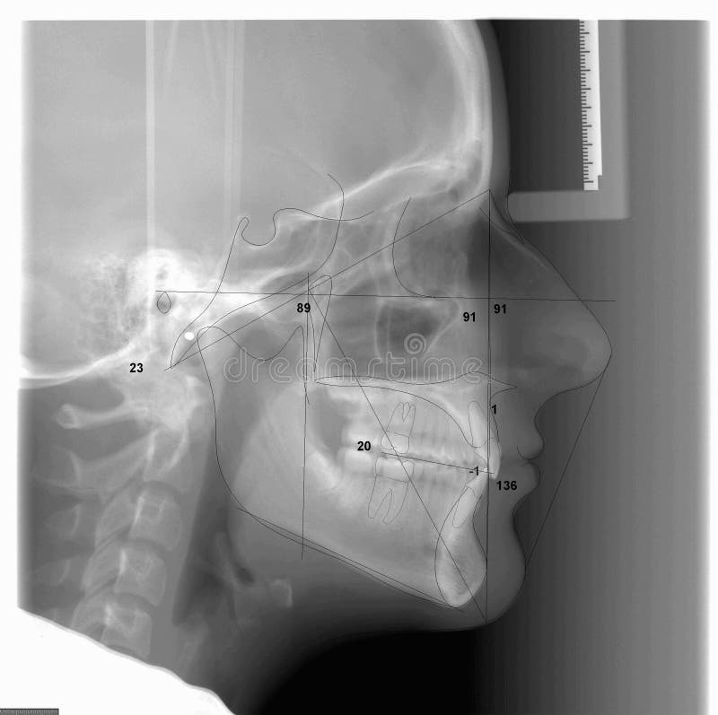 A Traced Cephalometric X-ray Stock Photo - Image: 7046610