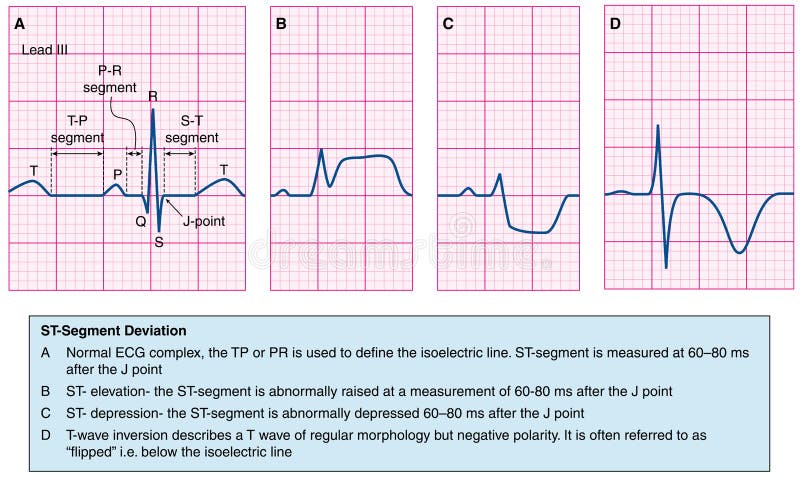 Traces Normales Et Anormales D'ecg Illustration de Vecteur - Image ...