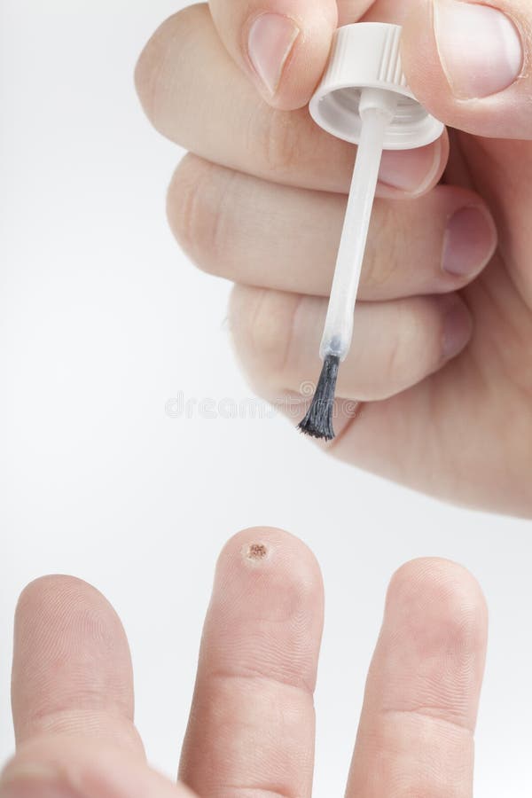 Traitement d'une verrue photo stock. Image du verrue - 12834232