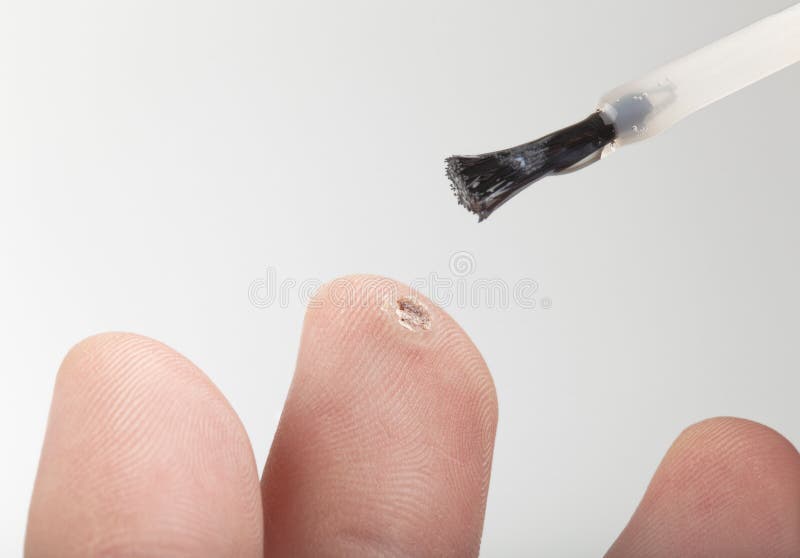 Traitement d'une verrue photo stock. Image du acide, soin - 17849672