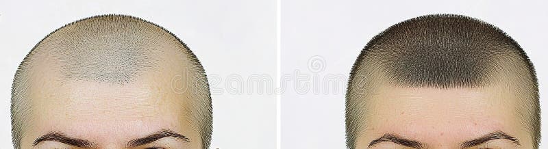 Transforming a Bald Head into a Fresh Buzz Cut with Clean Lines in a ...