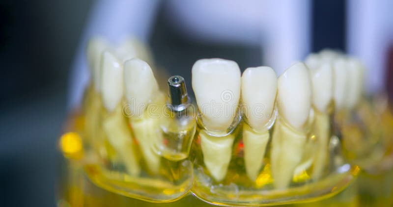 Transparent Model of Human Teeth with Implants Close-up Stock Video ...