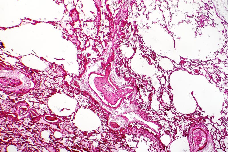 Transparent Thrombosis, Light Micrograph Stock Image - Image of ...