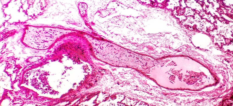 Transparent Thrombosis, Light Micrograph Stock Photo - Image of vessel ...