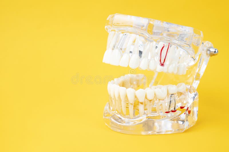 The Transparent Tooth Model with Dental Implant on Yellow Background ...