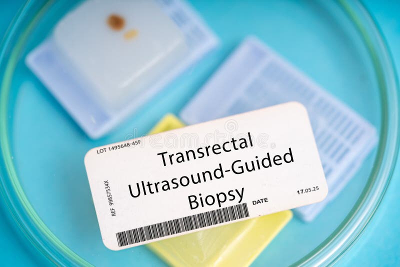 Transrectal Ultrasound-Guided Biopsy Stock Image - Image of evaluation ...