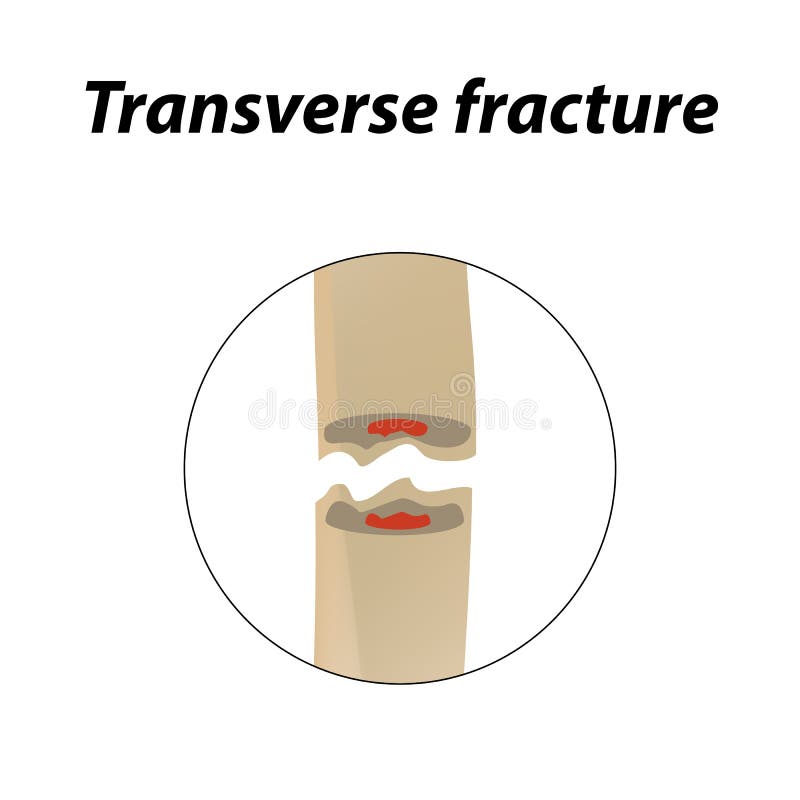 Transverse Bone Fracture. Infographics. Vector Illustration on a Lined ...