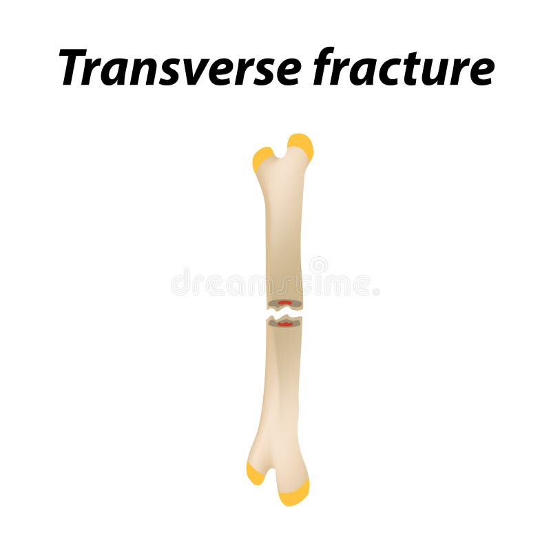 Types of Fracture. Fracture Bone Set. Infographics. Vector Illustration ...