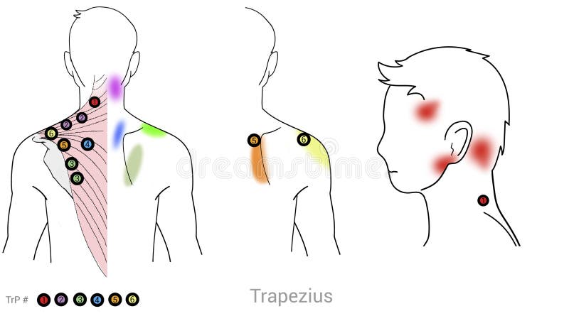 Trapezius Muscle: Managing Pain Arriving from Myofascial Trigger Points ...