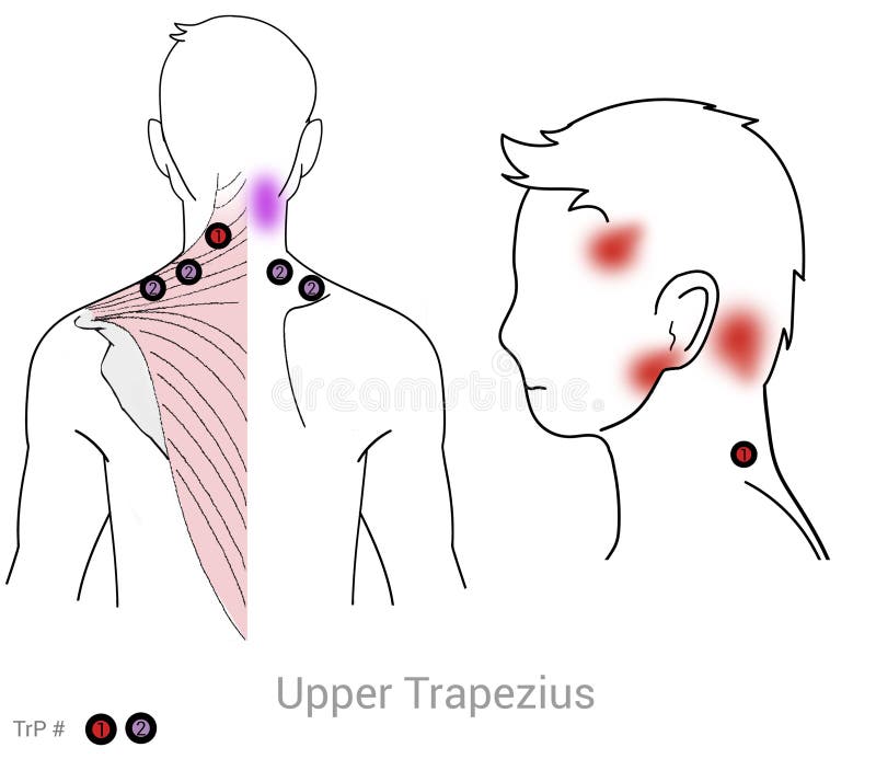 Upper Trapezius: Neck and Side Head Pain Stock Illustration ...