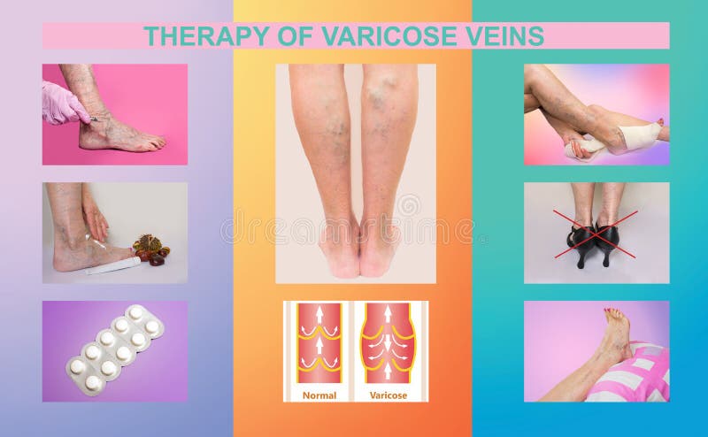 Tratamiento De Varicoso Antes Y Después Varices En Las Piernas Imagen ...