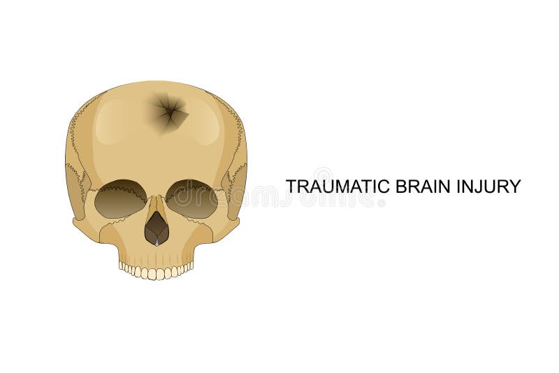 Traumatic Brain Injury Line Icon. Head Injury Treatment. Vector Signs ...