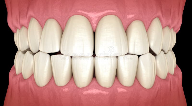 Traumatic Occlusion. Medically Accurate 3D Illustration Stock ...