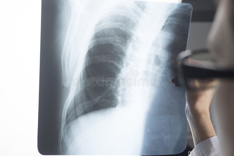 Roentgenogram of the Chest in a Child after Cardiac Surgery Stock Image ...