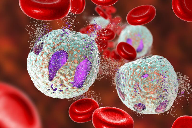 Acute Lymphoblastic Leukemia Stock Illustration - Illustration of ...