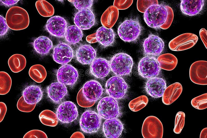 Treatment of Acute Lymphoblastic Leukemia Stock Illustration ...