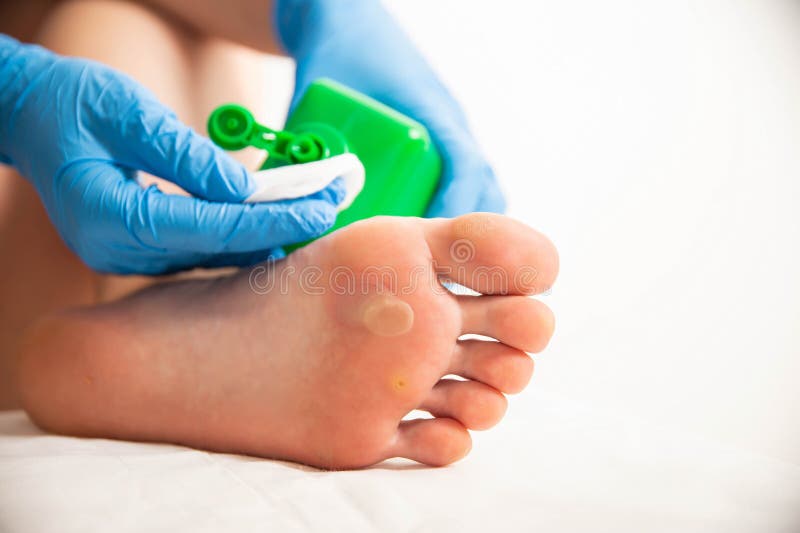 Treatment of a Callus on the Foot with a Special Solution after Surgery ...