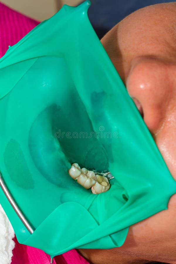 Treatment of a Chewing Tooth, the Dentist Put a Rubber Dam, Uses ...