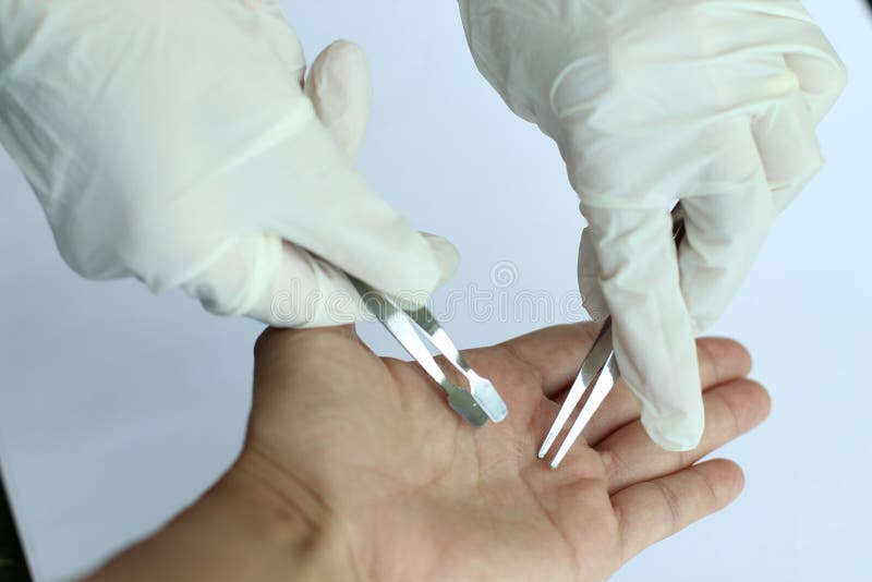 Treatment of the hands stock photo. Image of hospital - 147041312