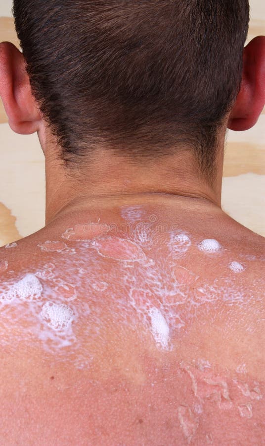 Treatment of Severe Sunburn Stock Image - Image of blistered, back ...