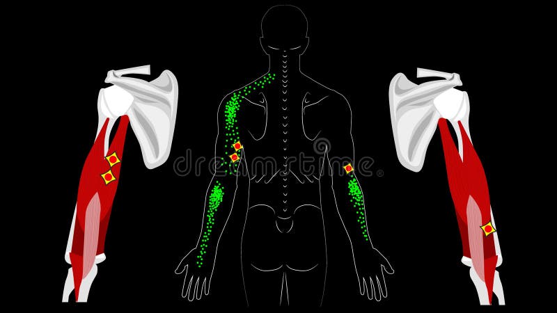 Triceps Brachii Muscle. Trigger Points and Referred Pain Stock ...