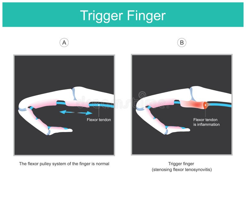Trigger finger diagram stock illustration. Illustration of bent - 279741844