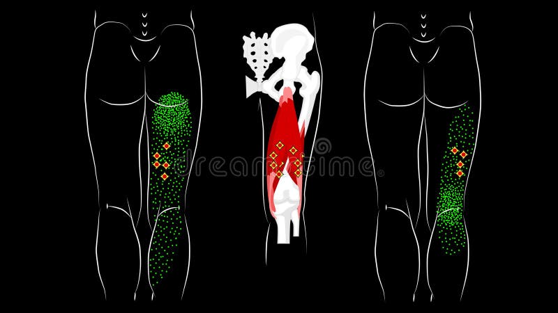 Trigger Points and Reflected Pain in the Hamstring Muscles. Stock ...