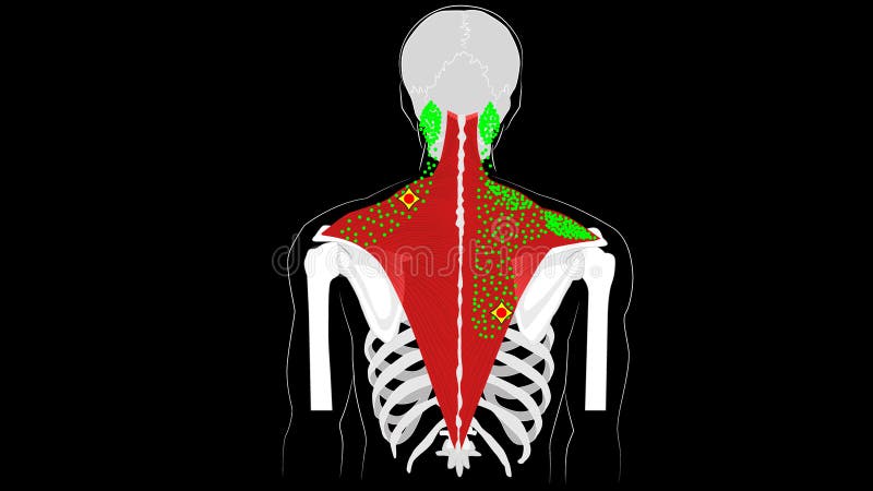 Trigger Points and Reflected Pain in the Trapezius. Anatomy Stock ...