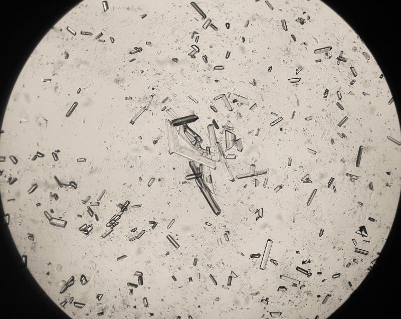 Amorphous Urates In Urine