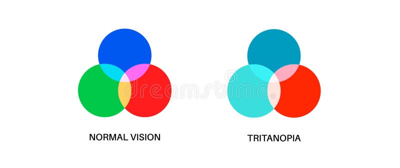 Tritanopia and tritanomaly stock vector. Illustration of medical ...